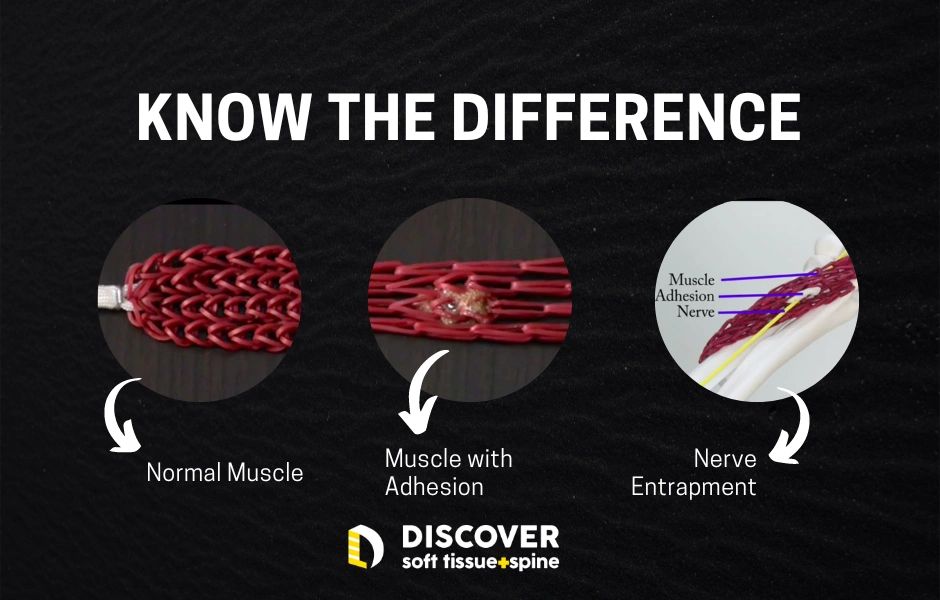 Understanding Normal Muscle to Adhesion to Nerve Entrapments